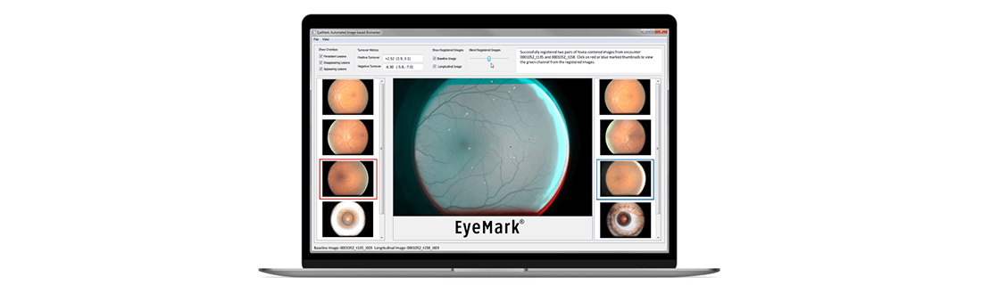 Automated Retinal Screening Opens a Window into People’s Health ...
